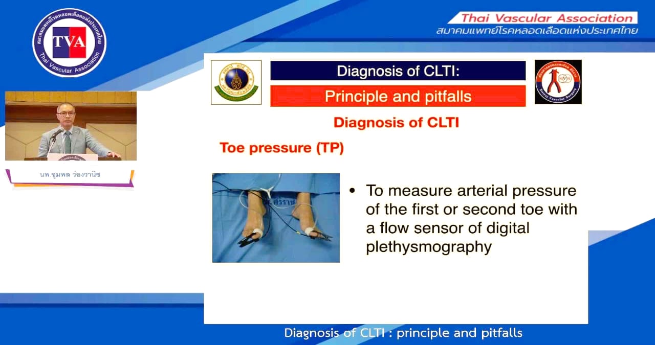 0601 - Diagnosis of CLTI: principle and pitfalls - สมาคมแพทย์โรคหลอด ...